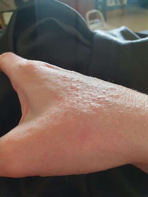 Itchy Hive Like Bumps From Chemical And Heat Exposure Best Treatment