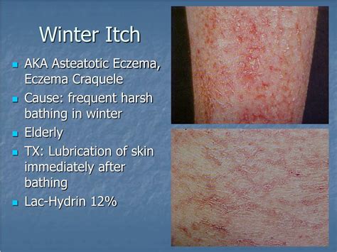 Eczema Winter Rash At Janet Wall Blog