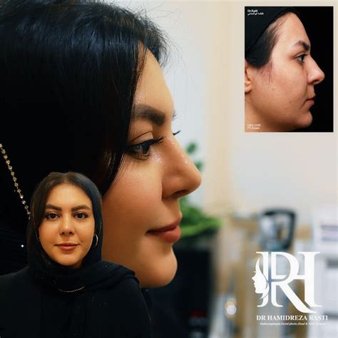 جراحی بینی دکتر حمیدرضا راستی متخصص گوش، حلق و بینی جراح بینی