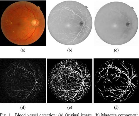 Figure 1 From Automated Detection Of Diabetic Retinopathy Using Svm