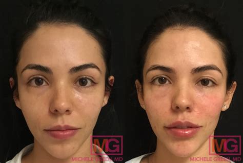 What Is The Botox Lip Flip Procedure Dr Michele Green Md
