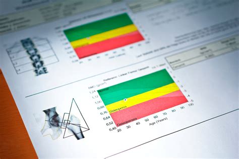 Good Bone Calcification Is Associated With A Better Breast Cancer Prognosis Dexeus Campus