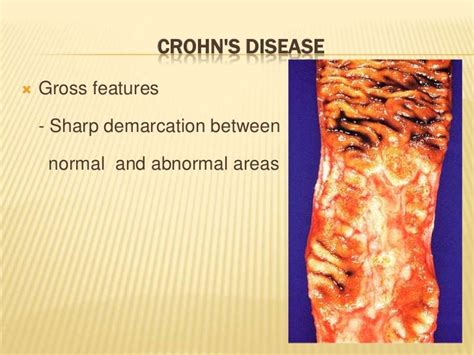 Crohns Disease Cobblestone At Oscar Nimmo Blog