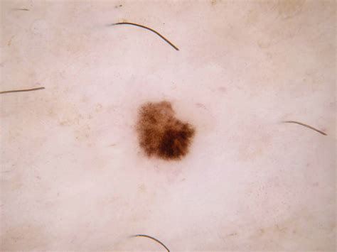 Skin Cancer Object Detection Dataset V1 2022 05 14 11 24pm By Skin Cancer