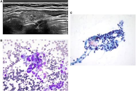 A‐c A Solid And Isoechoic Thyroid Imaging Reporting And Data System