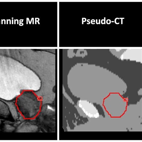 The Mr Planning Was Used To Generate A Pseudo Ct For Treatment Planning