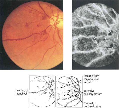 Venous Loop Retina Venous Loop Retina