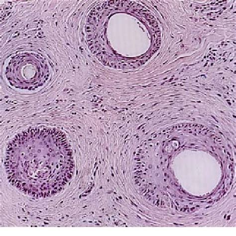 Scalp Pathology In Androgenetic Alopecia Horizontal Section