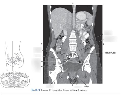 Diagram Of Coronal Ct Of Female Pelvis With Ovaries Quizlet