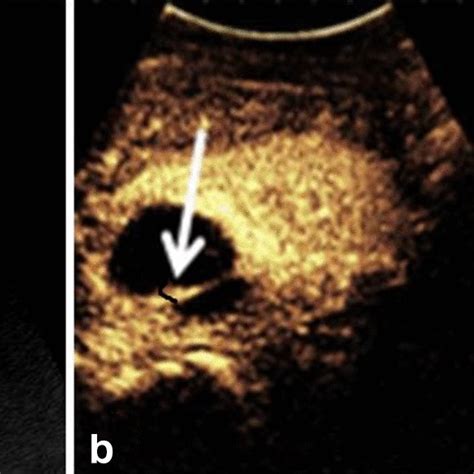 B Mode Us A Image Shows A Solid Cystic Appearing Exophytic Mass Arising