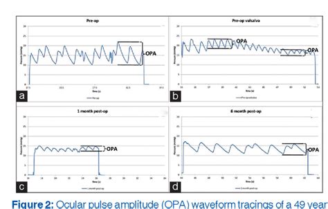 Figure 1 From Ocular Pressure Waveform Reflects Ventricular Bigeminy And Aortic Insufficiency