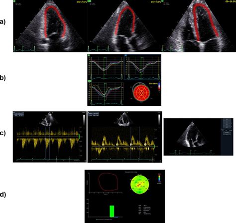 Practical Assessment Of Myocardial Work A Global Longitudinal Strain