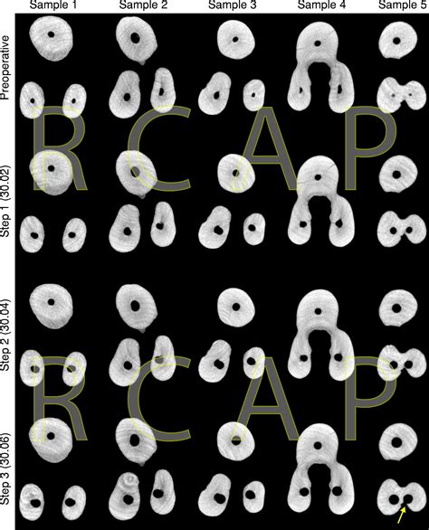 The Root Canal Anatomy Project Three Rooted Maxillary Premolar