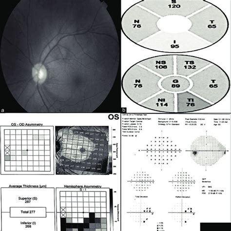 Oct Image Of The Temporal Sclera A Ciliary Muscle B Scleral Spur