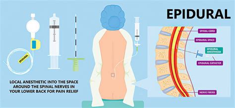 Epidural Injections Trimed Spine And Joint