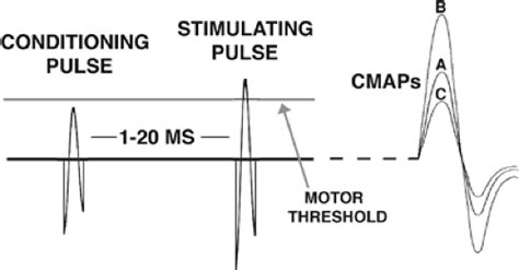 Transcranial Magnetic Stimulation Neupsy Key