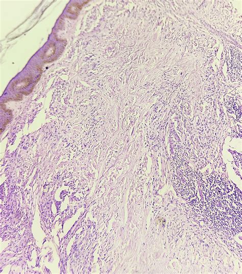 Photograph Of Annular Elastolytic Giant Cell Granuloma Showing Elastic Download Scientific