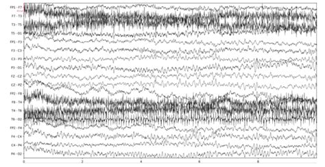 Automatic Eeg Artifact Removal Using Blind Source Separation Meth