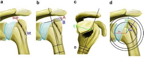 Isolated Fracture Of The Greater Tuberosity Prediction Of Superior And