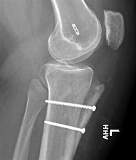 Tibial Tubercle Osteotomy Technique Indication Contraindication