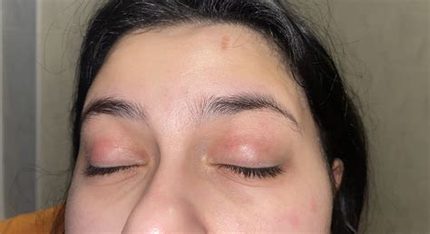 Лишеи на лицето и около очите Профилактика Мнения от Bg Mamma