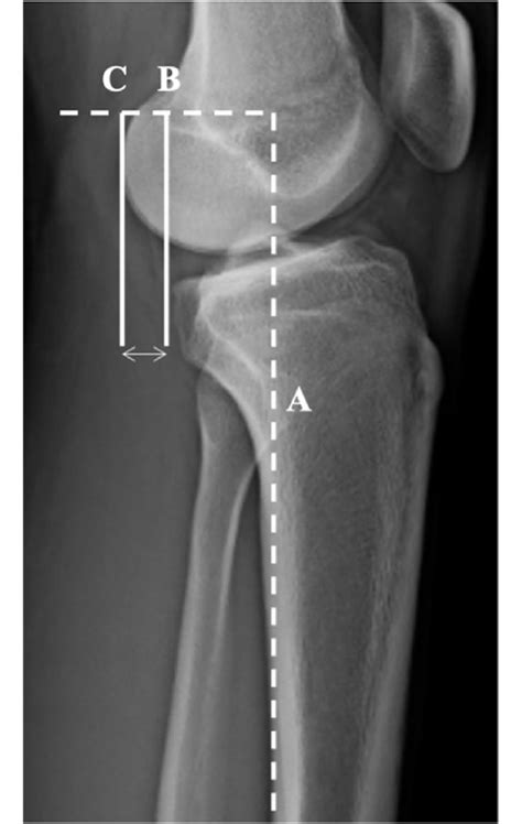 Lateral Right Knee Radiograph Demonstrating Static Anterior Tibial