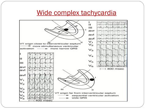 Wide Qrs Tachycardia Ppt