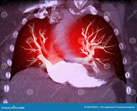 Cta Chest Or Ctpa With Contrast Media 3d Rendering For Diagnostic Pulmonary Embolism Pe Stock