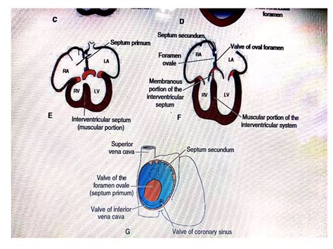 Atrioventricular Canal Defect Pptx Heart And Cardiovascular Diseases Diseases And Conditions