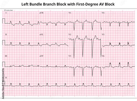 Vecteur Stock Ecg First Degree Av Block With Lbbb Left Bundle Branch
