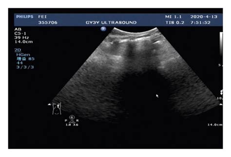 Right Congenital Cystic Adenoid Malformation Of The Lung Ct Indicates
