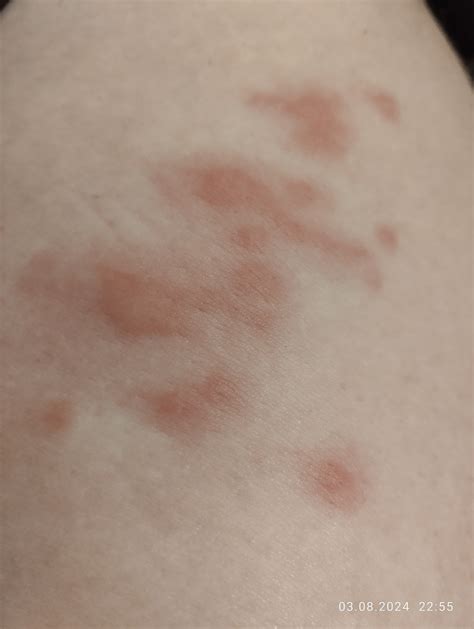 Пятна на коже зудят и чешутся Пятна на коже появились с утра Выпуклые Medaboutme