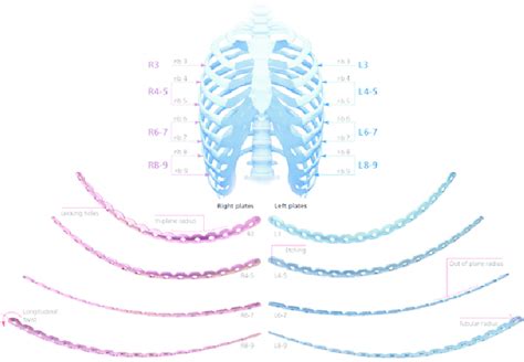 The Synthes Matix RIB Plating System Precontoured Titanium Alloy Download Scientific Diagram