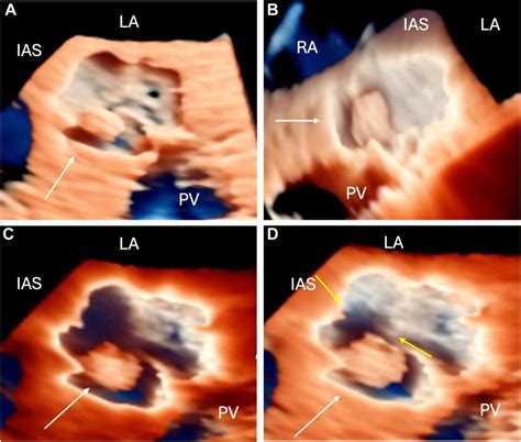 American Society Of Echocardiography On Linkedin Characterization Of