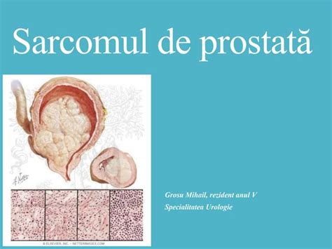 Prostatic Sarcoma Ppt