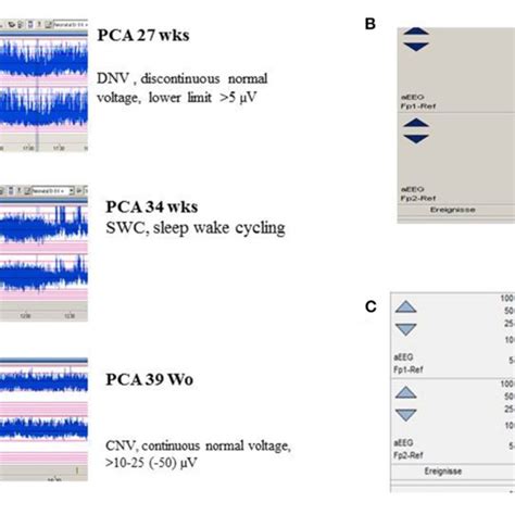 Eeg Findings In A Female Neonate With Stxbp1 Associated Ee At The Age