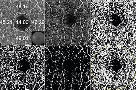 Indian Journal Of Ophthalmology