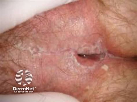 Genital Lichen Planus Images DermNet