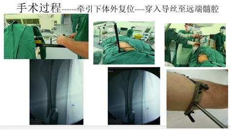 一篇掌握股骨骨折闭合复位髓内钉固定术 好医术早读文章 好医术 赋能医生守护生命