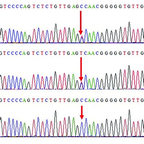 Chromatogram Of Sanger Sequence Analysis Iii 1 And I 2 Are The Normal