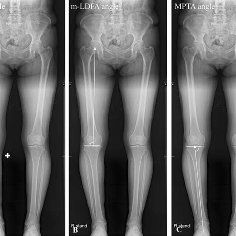 Schematic Measurement Of The Medial Joint Space Width Mjsw Joint