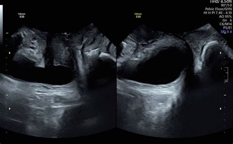 Ics 2021 Abstract 121 Usability Of Transperineal Ultrasound For The Evaluation Of Pelvic Organ