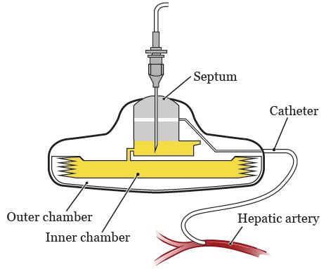 About Your Liver Hepatic Artery Infusion Pump Memorial Sloan