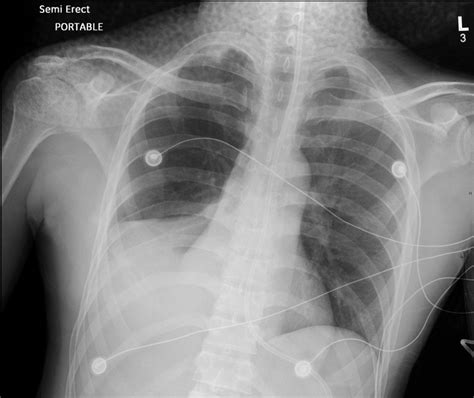 Atelectasis Alveoli Collapse