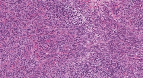 Adenosarcoma Of The Uterus Ottawa Atlas Of Pathology