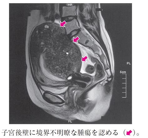 A 子宮腺筋症 国試 M E Medical