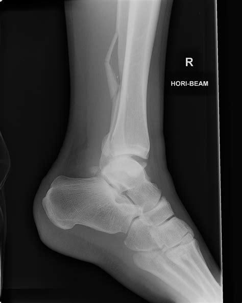 X Ray Ankle Dislocation Medworldonline