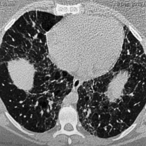 Female Patient 36 Years With Nodular Pattern In Hrct Chest Low