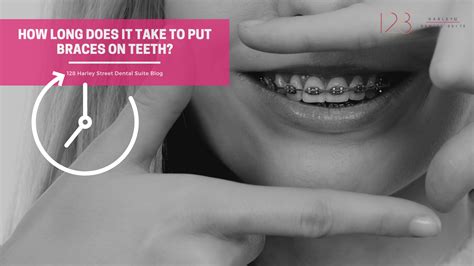 How Long Does It Take To Put Braces On Teeth Harley Street Dental