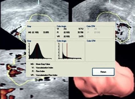 Cervical Vascularization In The 4 Dimensional View Download